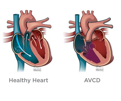 Canal Arterial Fetal Complete Atrioventricular Canal Defect Cavc