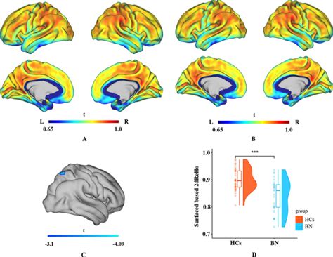 Uncovering Neural Pathways Underlying Bulimia Nervosa Resting State Neural Connectivity