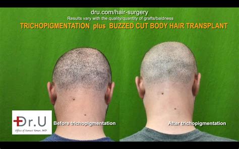 Video Drugraft Fue Plus Smp Scalp Micropigmentation