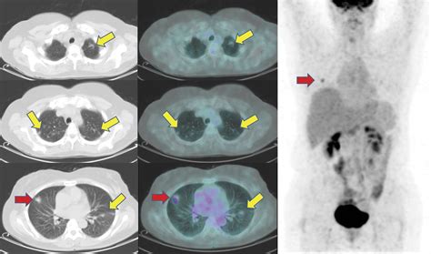 Nodular Nongranulomatous Vasculitis Of The Lung Detected By Clinical Nuclear Medicine