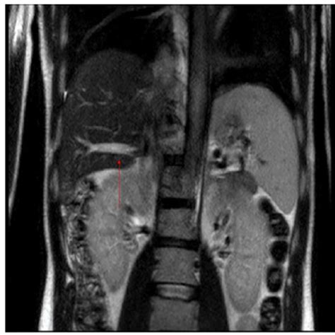 Cholangiography Mri That Ruled Out Any Bilio Pancreatic Diseases But Download Scientific