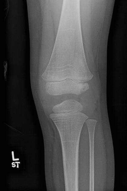 Osteomyelitis Radiopaedia Pediatric Musculoskeletal Infections