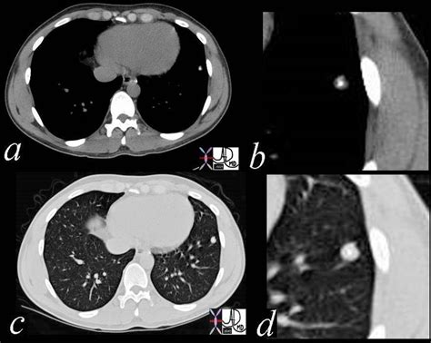 Nodules Calcified The Common Vein