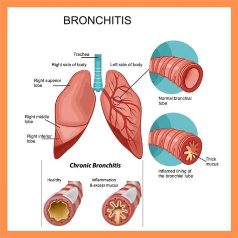 Obat Herbal Bronchitis Tasikmalaya