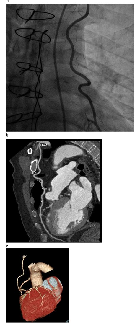 A Ica Of A Male Patient Post Cabg Showing Lima Graft Cannulation B