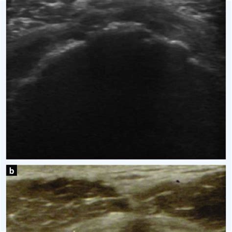 Patte Classification Of Full Thickness Rotator Cuff Tear A Stage 1 Download Scientific