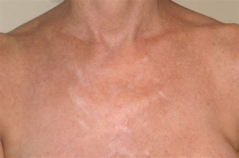 Hypopigmentation Back
