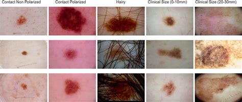 Example Images From ISIC Dataset With Different Attributes Download Scientific Diagram