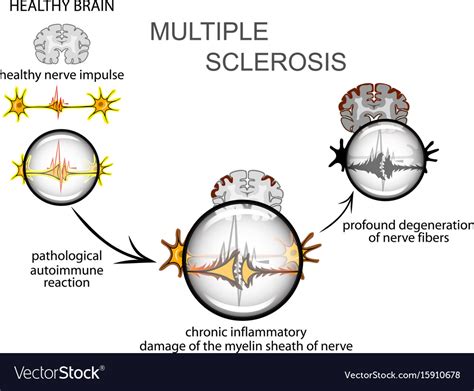 Multiple Sclerosis Neurology Royalty Free Vector Image