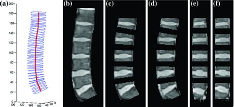 3d Lumbar Intervertebral Disc Segmentation From Mri Data Sets