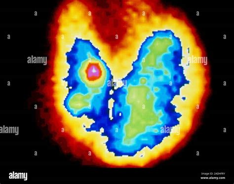 Multinodular Goitre Coloured Gamma Scan Of A Goitre Of The Thyroid Gland In Front View The