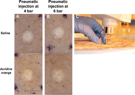Skin Papule As Clinical Endpoint A Skin Papule Served As Predefined