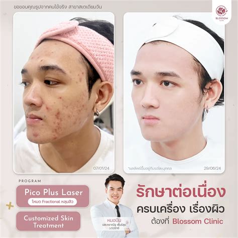Pico Laser คืออะไร ทำไมถึงยอดนิยม ลดกระ ฝ้า ที่ Blossomclinic