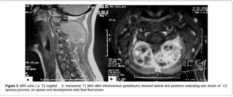 Aneurysmal Bone Cyst Spine Mri