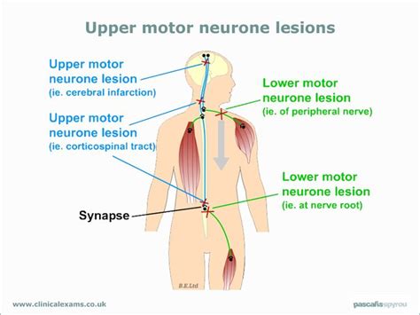 Upper And Lower Motor Neuron Lesions Motor Neuron Disease Treatment