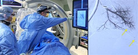 Pulmonary Avm Embolization Journal Of Medical Insight Melanie At