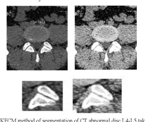 Figure 5 From Kernel Based Fcm For Spinal Cord Segmentation On Computed