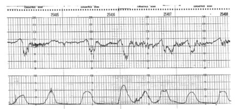 Fetal Monitoring Strips Flashcards Quizlet