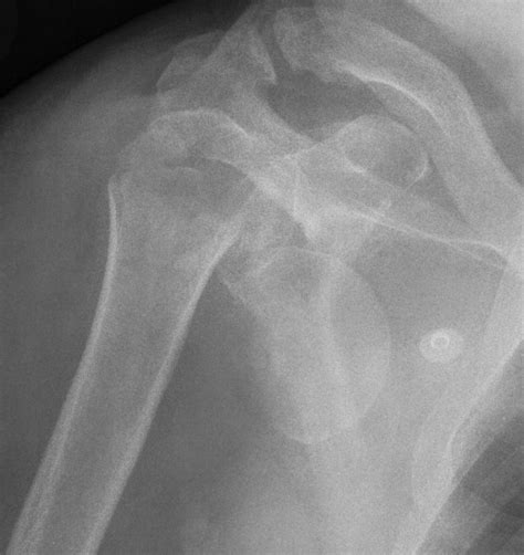 Proximal Humerus Fracture The Bone School