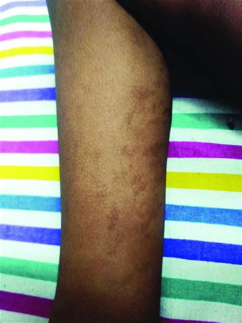 Hyperpigmented Type Of Pigmentary Mosaicism Along Blaschkos Lines