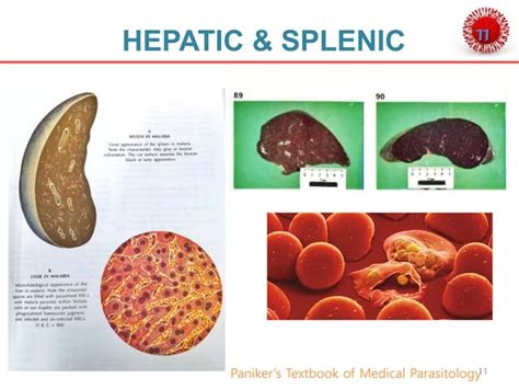 Pathogenesis Of Malaria Pptx