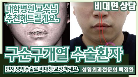 Sub 구순구개열 수술받은 환자 먼저 양악수술로 비대칭 교정을 하세요 비대면상담 111 Patient Who