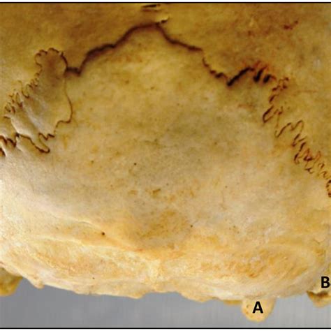 Inferior View Of The Skull A Right Paramastoid Apophysis B Right