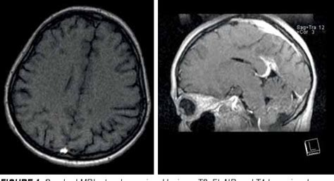 Figure 1 From Anti Nmda Receptor Encephalitis In A Young Woman A Diagnostic Challenge
