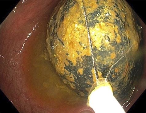 Beyond The Biliary Tree A Giant Calcified Rectal Fecalith Treated With