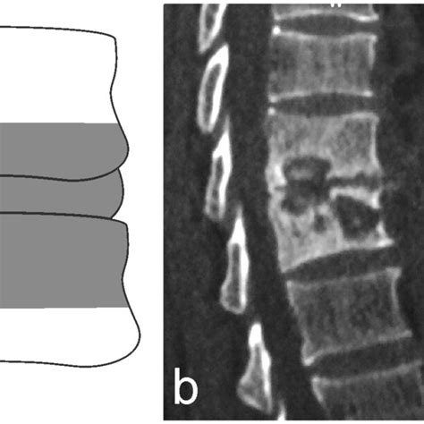 Illustrations Of Od Classification Grades 0 To 5 Corresponding To