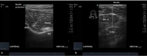 A Pericapsular Nerve Group Neurolytic Block B Obturator Nerve