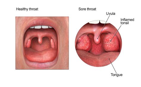 Common Symptoms Of Strep Throat And What You Can Do About It