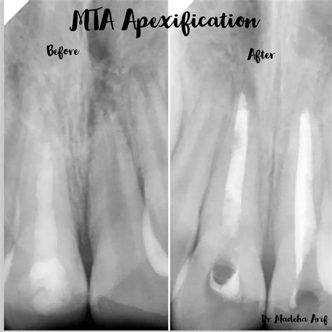Dr Madeeha Arif On Linkedin Dentaltrauma Apexification Endodontics