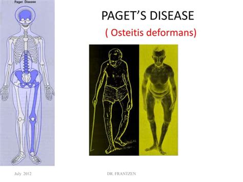 Paget Disease Ppt