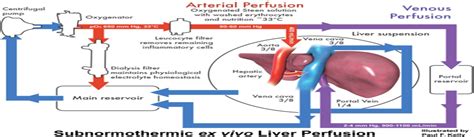 Subnormothermic Ex Vivo Liver Perfusion Is A Safe Alternativ Liver