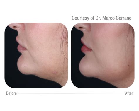 Cellbooster® Shape Suisselle