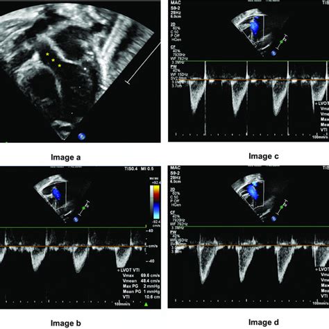 Measurement Of Lvot And Rvot Diameter A Shows Lvot In Plax View With