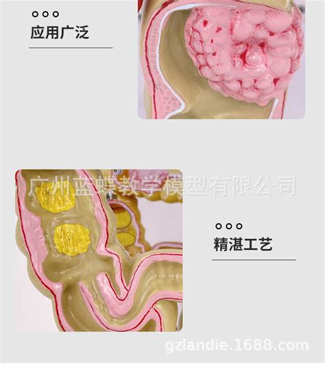 Simulation Teaching Colon Pathology Model Colorectal Lesion Specimen Intestinal Doctor Patient