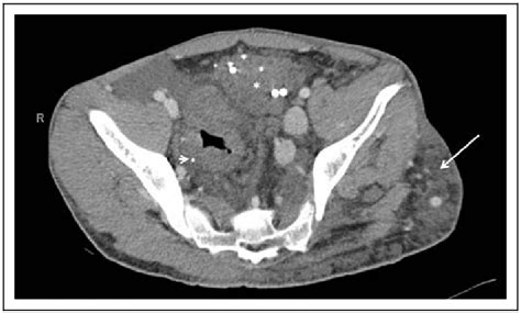 Showing The Round Grayish Structure Found Behind The Sigmoid Colon With Download Scientific