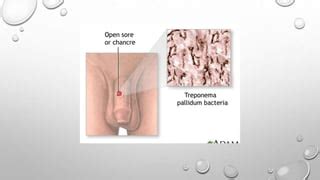 Syphilis PPTX