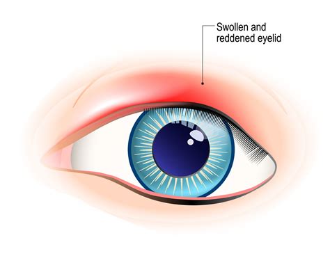 Chalazion Home Treatment Symptoms And Prevention