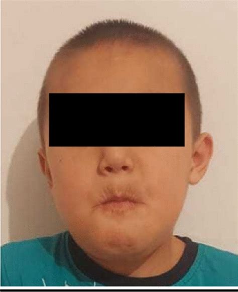 Interdisciplinary Treatment Of Macroglossia Due To A Microcystic