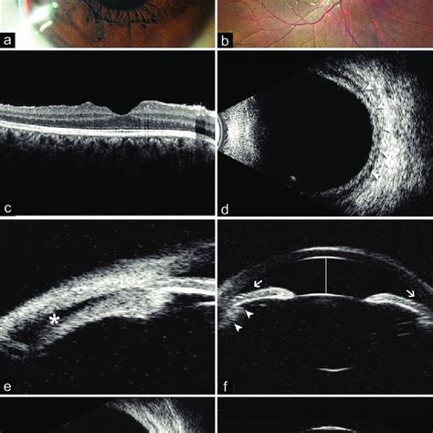 a slit lamp image of the right eye showing shallow anterior chamber