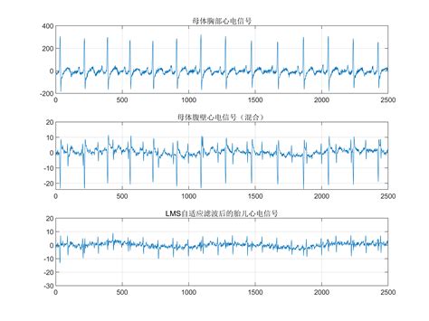 课程设计项目2 3：孕妇心电图中胎儿心电信号的提取 孕妇心电图提取 csdn博客