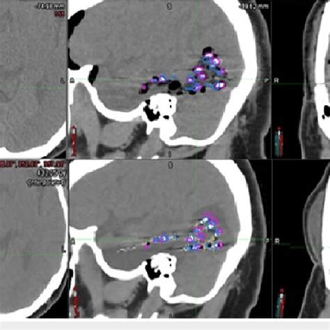Seed Positions Identified On Day One And Day Post Implant CT Images Download Scientific