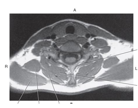 Cervicle Spine Quiz Cervicle Spine Quiz
