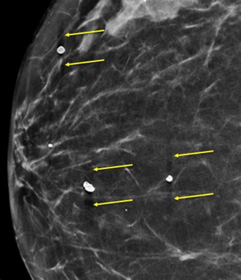 Shadow Artifact Arrows Caused By Dystrophic Calcifications On Download Scientific Diagram