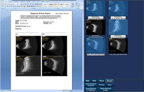 B Scan Plus Ophthalmic Ultrasound Equipment