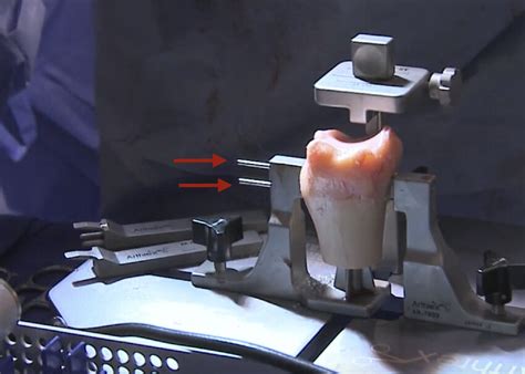 The Distal Tibia Allograft Must Be Placed With The Cartilaginous