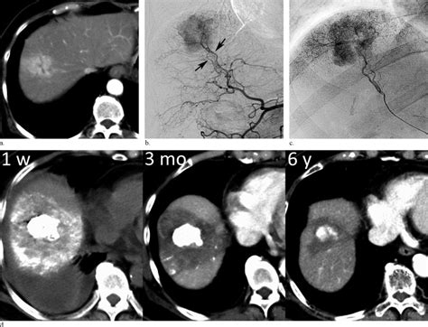 Superselective Conventional Transarterial Chemoembolization For Hepatocellular Carcinoma